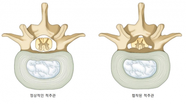 [EBS 명의] 수술이 답? 무릎-척추 통증을 잡아라!...방사통 종류, 원인, 치료법 : zum 뉴스