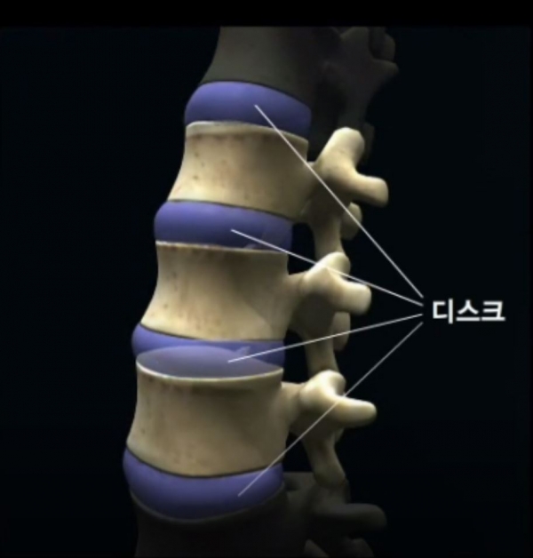 [EBS 명의] 수술이 답? 무릎-척추 통증을 잡아라!...방사통 종류, 원인, 치료법 : zum 뉴스